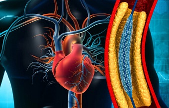 Best Angioplasty Specialist Fortis Hospital Mulund, Mumbai | Dr ...